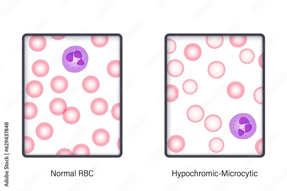 Vetor de The difference of Normal red blood cell and Hypochromic ...