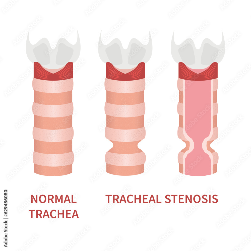 Tracheal stenosis awareness illustration. Trachea narrowing symbol ...