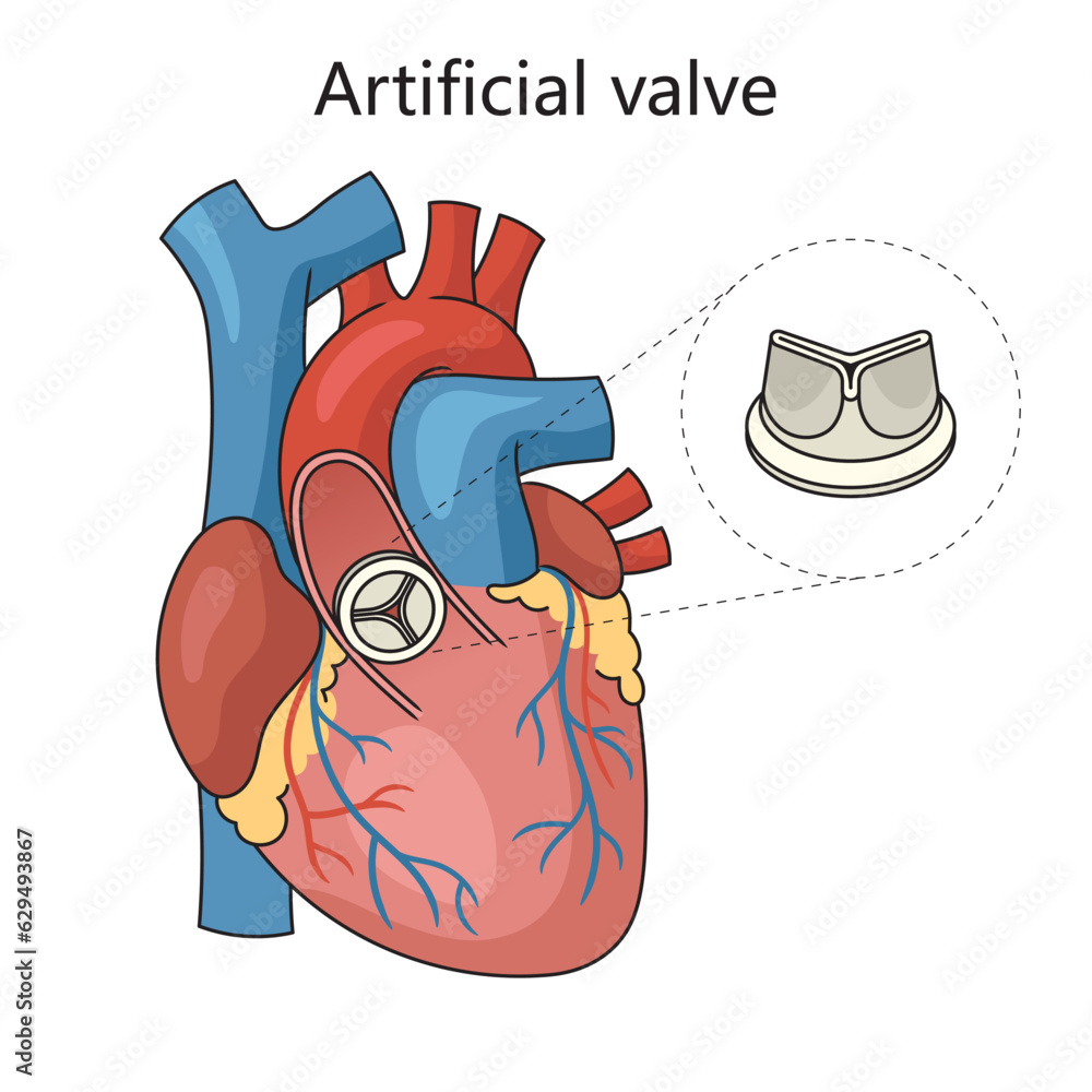 Artificial heart valve in human heart diagram schematic vector ...