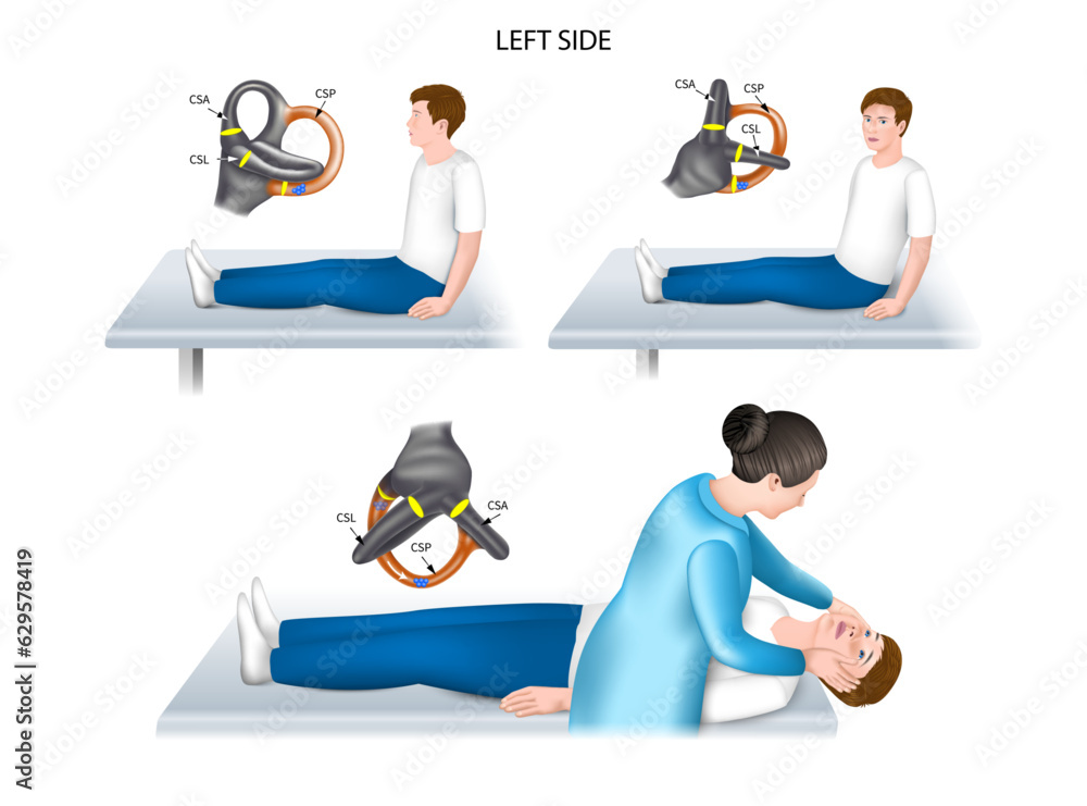 Dix-Hallpike test left Stock Vector | Adobe Stock