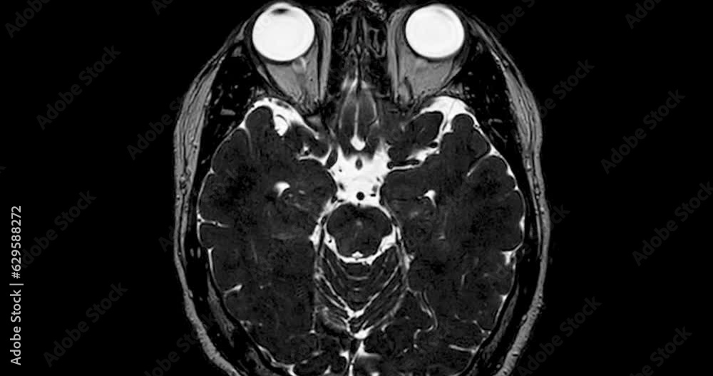 MRI Brain scan with the internal auditory canal (IAC) axial view. Stock ...
