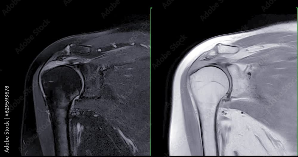 Magnetic Resonance Imaging or MRI of Shoulder Joint Coronal T2FS and ...