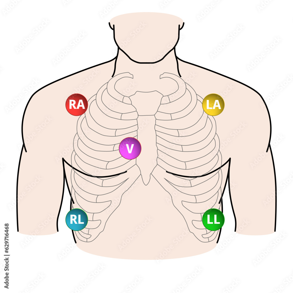 5 Lead Electrode Placement Electrocardiogram - RA, LA, RL, LL, V - Position of ECG 5 Leads ...