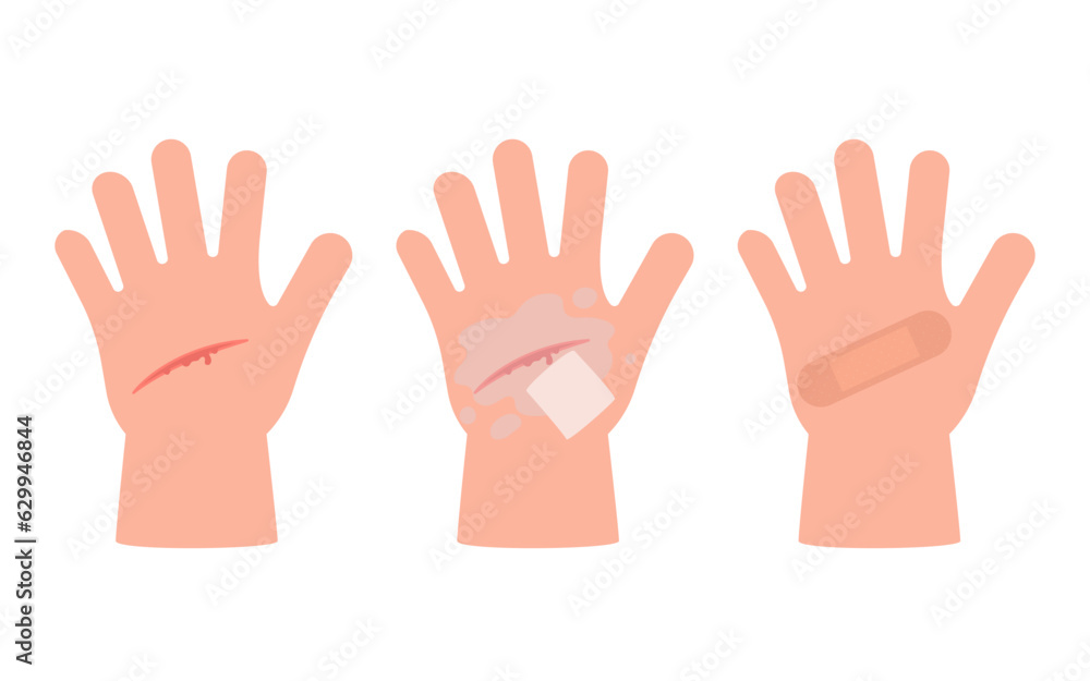 Wound of hand kid skin, scratch. First aid for cut injury skin ...
