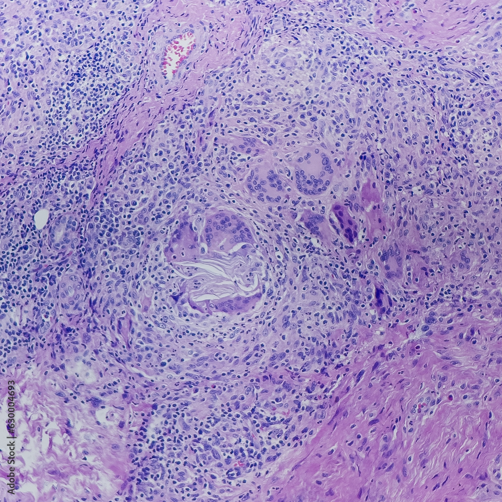 Camera Photo Of Ruptured Epidermal Inclusion Cyst Showing Keratin