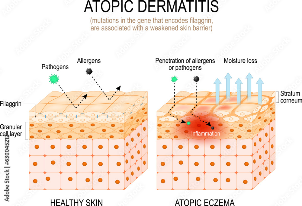 Filaggrin and Atopic dermatitis. eczema Stock Vector | Adobe Stock Filaggrin and Atopic dermatitis. eczema Stock Vector | Adobe Stock