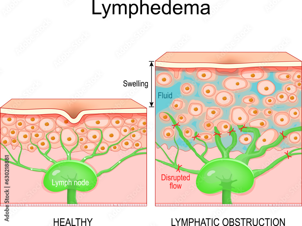 Lymphedema. Cross section of a human skin Stock Vector | Adobe Stock