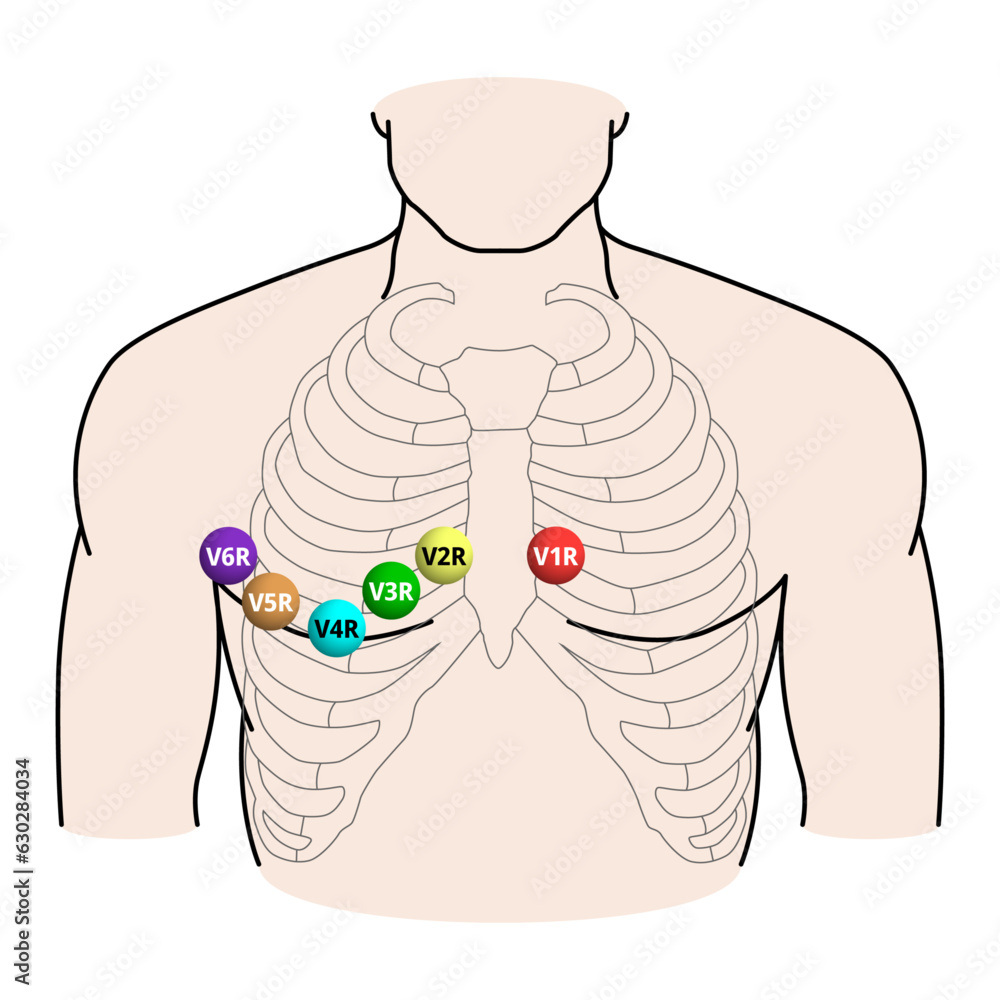 Right Sided Ecg Electrode Placement Electrocardiogram Lead V1r V2r V3r V4r V5r V6r