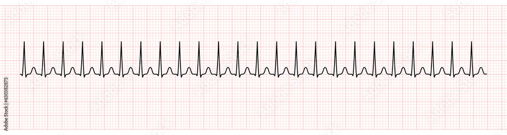 Paroxysmal Atrial Tachycardia Ecg