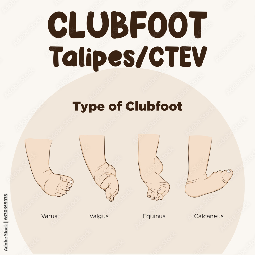 Line art vector types of clubfoot. Foot turn inward or upward. Type of ...