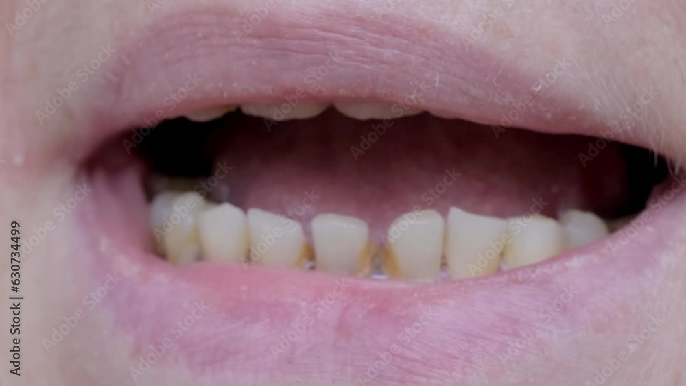 patient with open mouth, yellow tartar, dental calculus, hard plaque ...