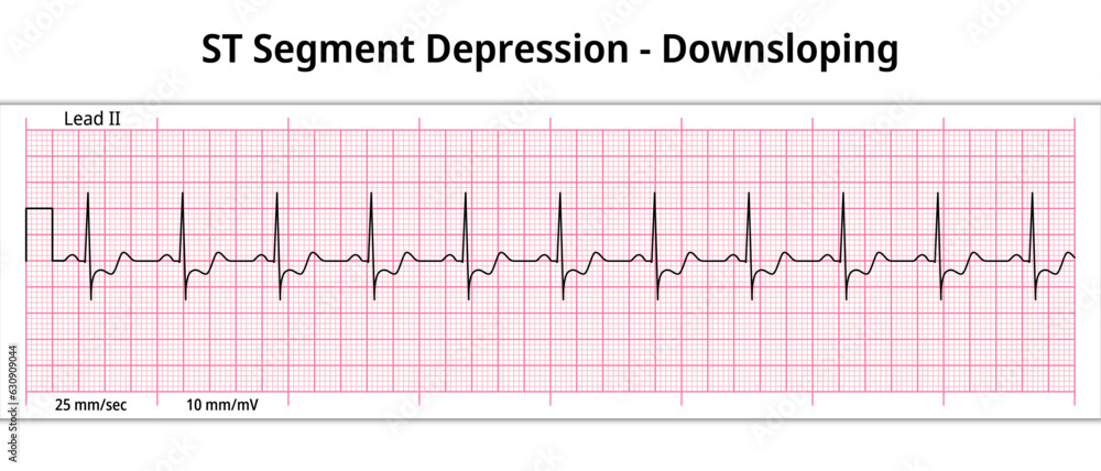 ECG ST Segment Depression - Downsloping - 8 Second ECG Paper ...