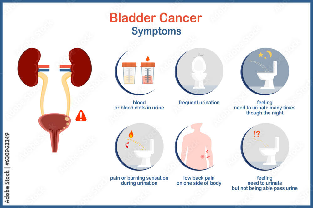 medical vector illustration infographic bladder cancer, bladder cancer ...