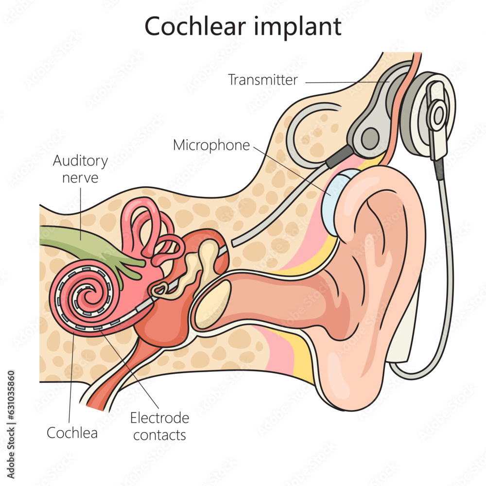 Poster Cochlear implant structure vertebral column diagram schematic ...