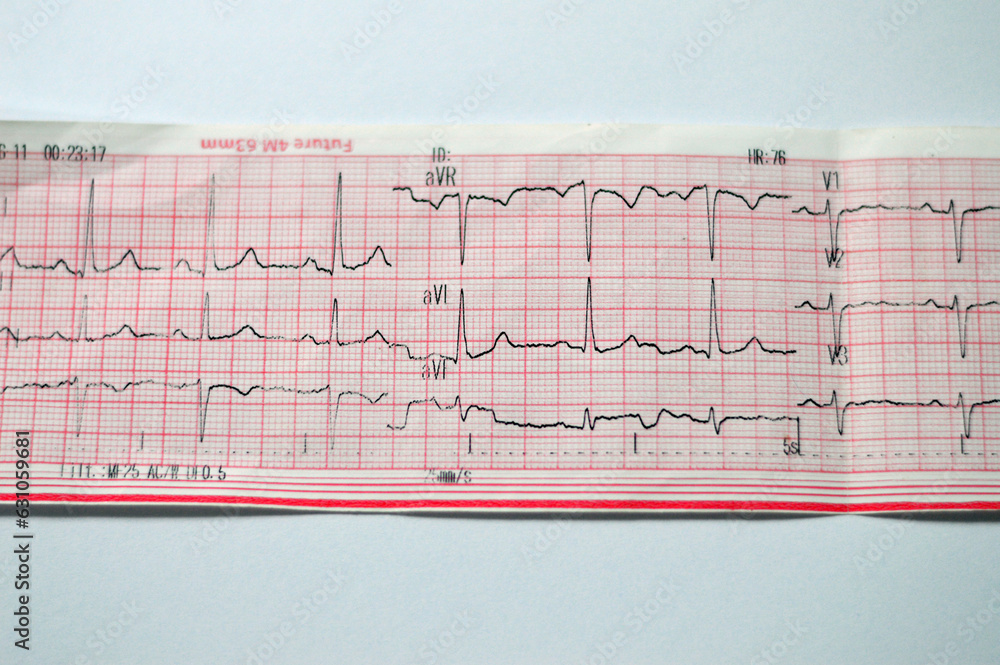 An ElectroCardioGraph ECG, a chart that draws the electricity of the ...