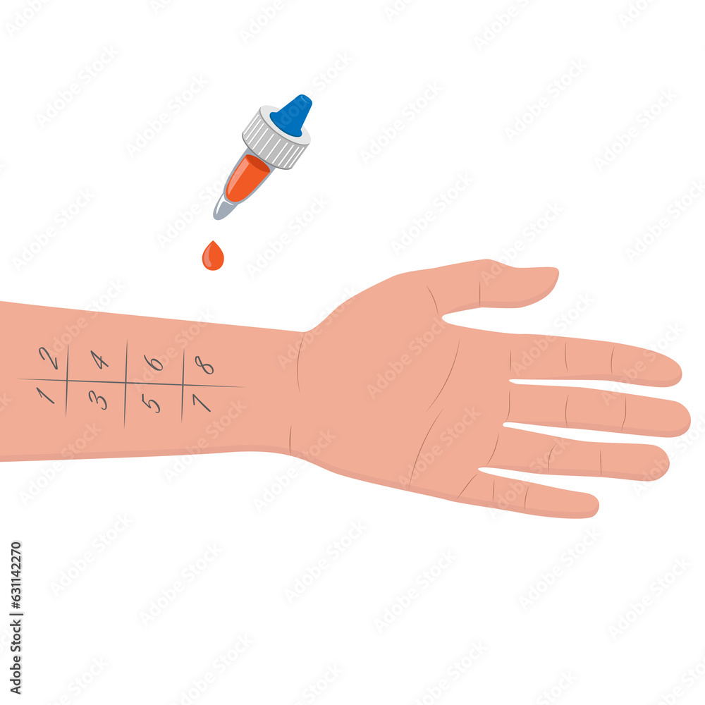 Allergy test. Hand with pipette. Medical research flat design. Patient ...
