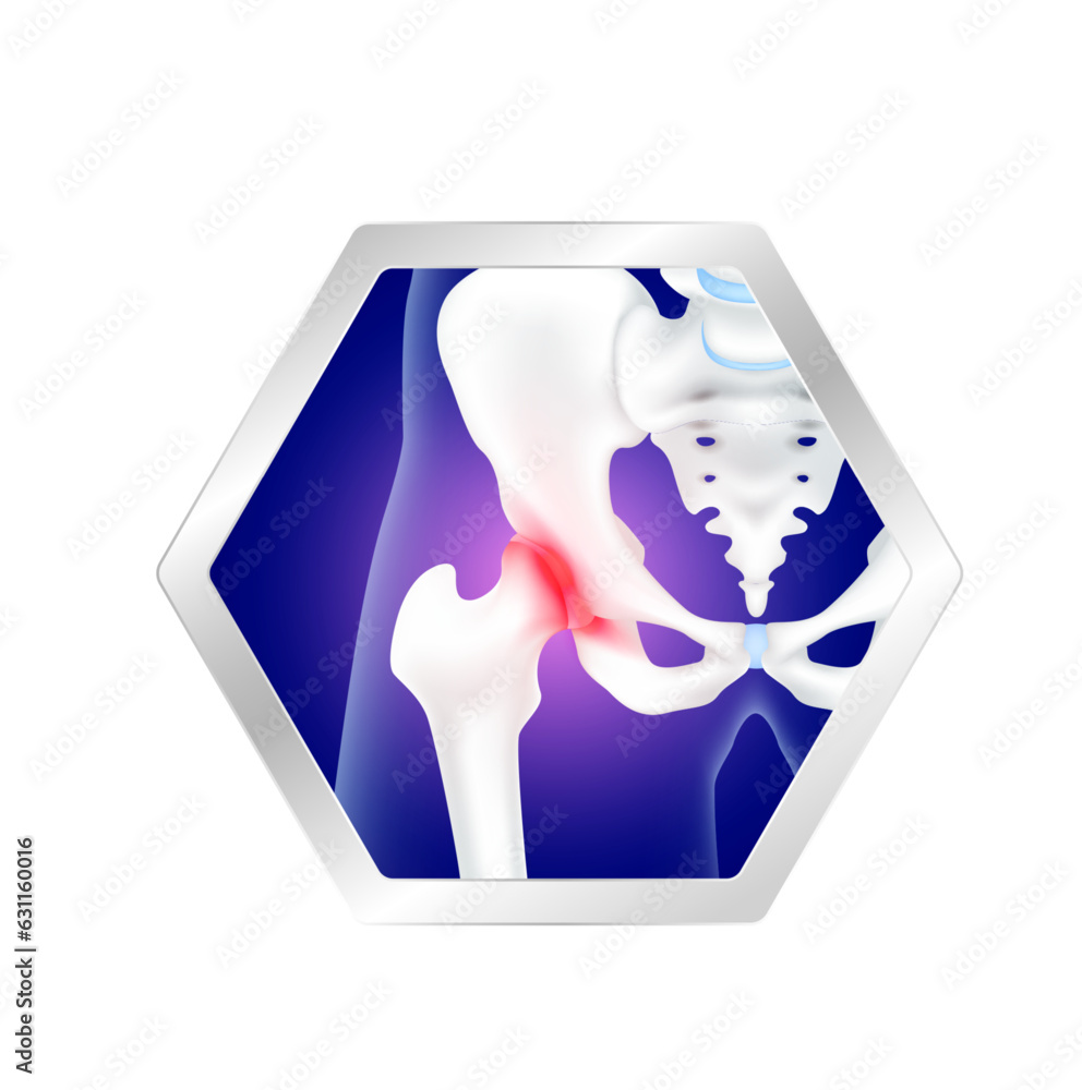 Hip bone, pelvis and degenerative joint in hexagon label aluminum ...
