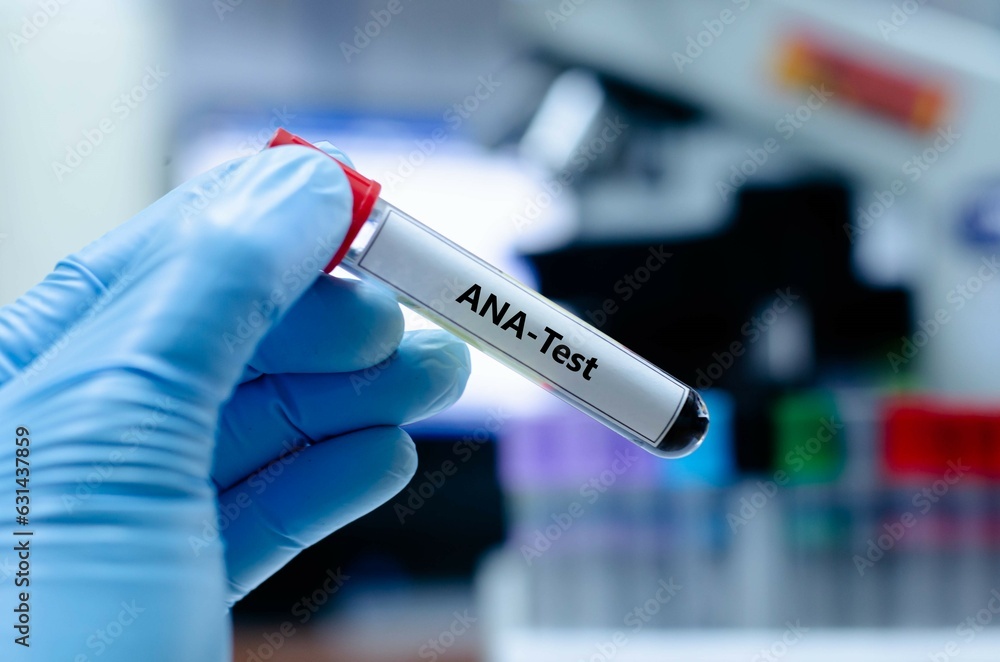 Blood sample of patient positive test for anti-nuclear antibody ...