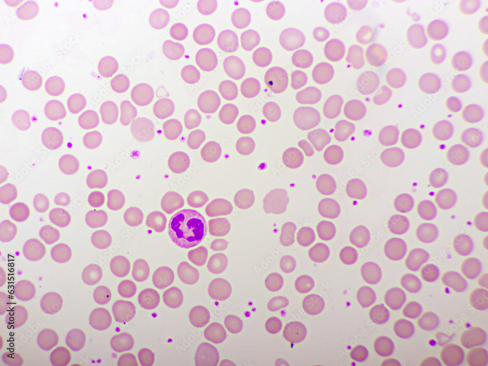 Segmented neutrophil cell in human blood smear, analyze by microscope ...