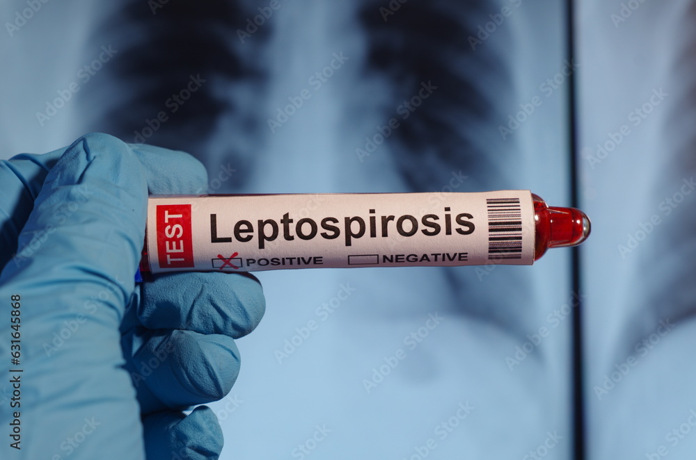 Foto de Blood collection tubes Leptospirosis test positive results ...