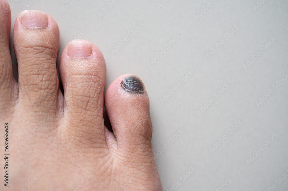 Foto de Cropped shot view of black nail called runner's toe. Runner's ...