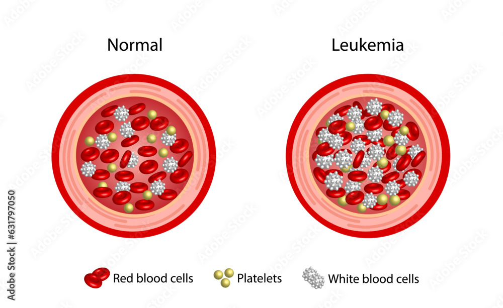 Leukemia, blood cancer. Difference between healthy normal blood and ...