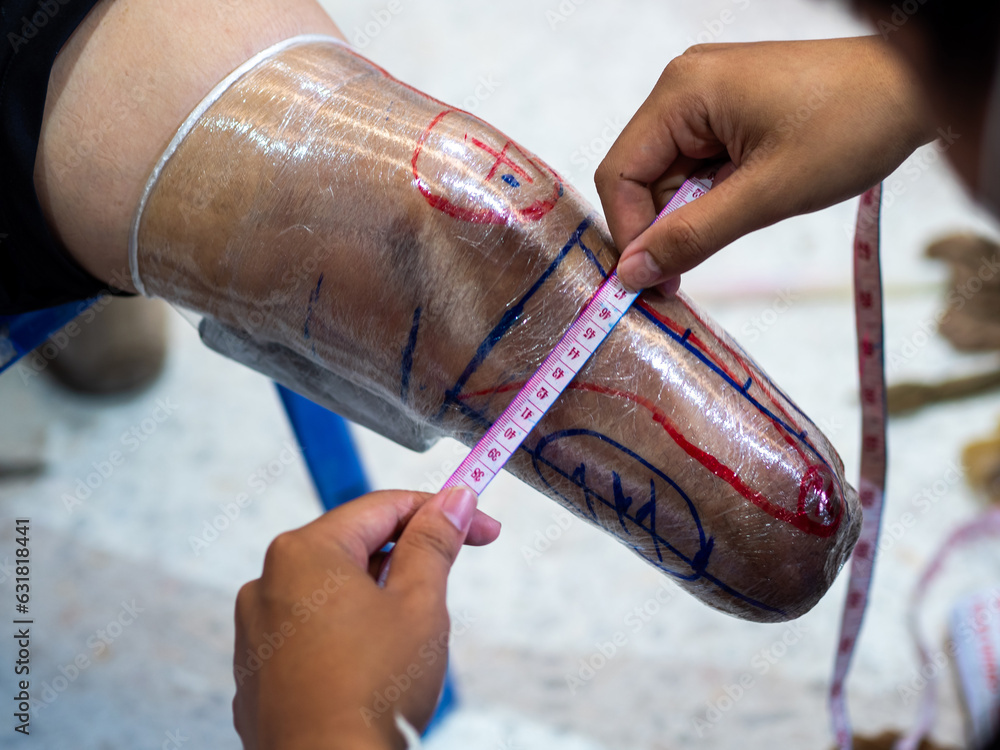 Medical personnel measuring amputated leg to make a prosthetic leg ...