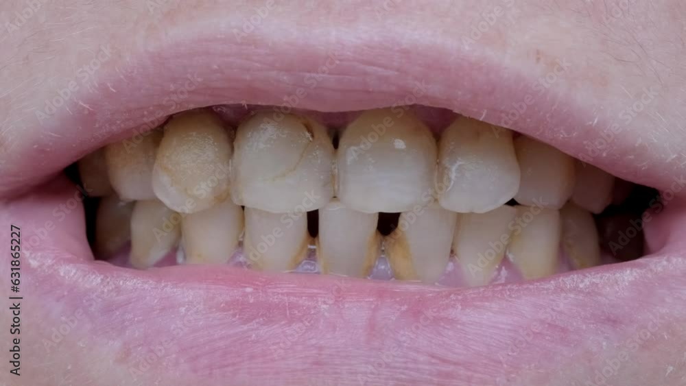 patient with open mouth, yellow tartar, dental calculus, hard plaque ...