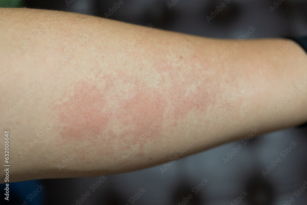 Allergic rash dermatitis eczema skin of patient. hand in scratching ...