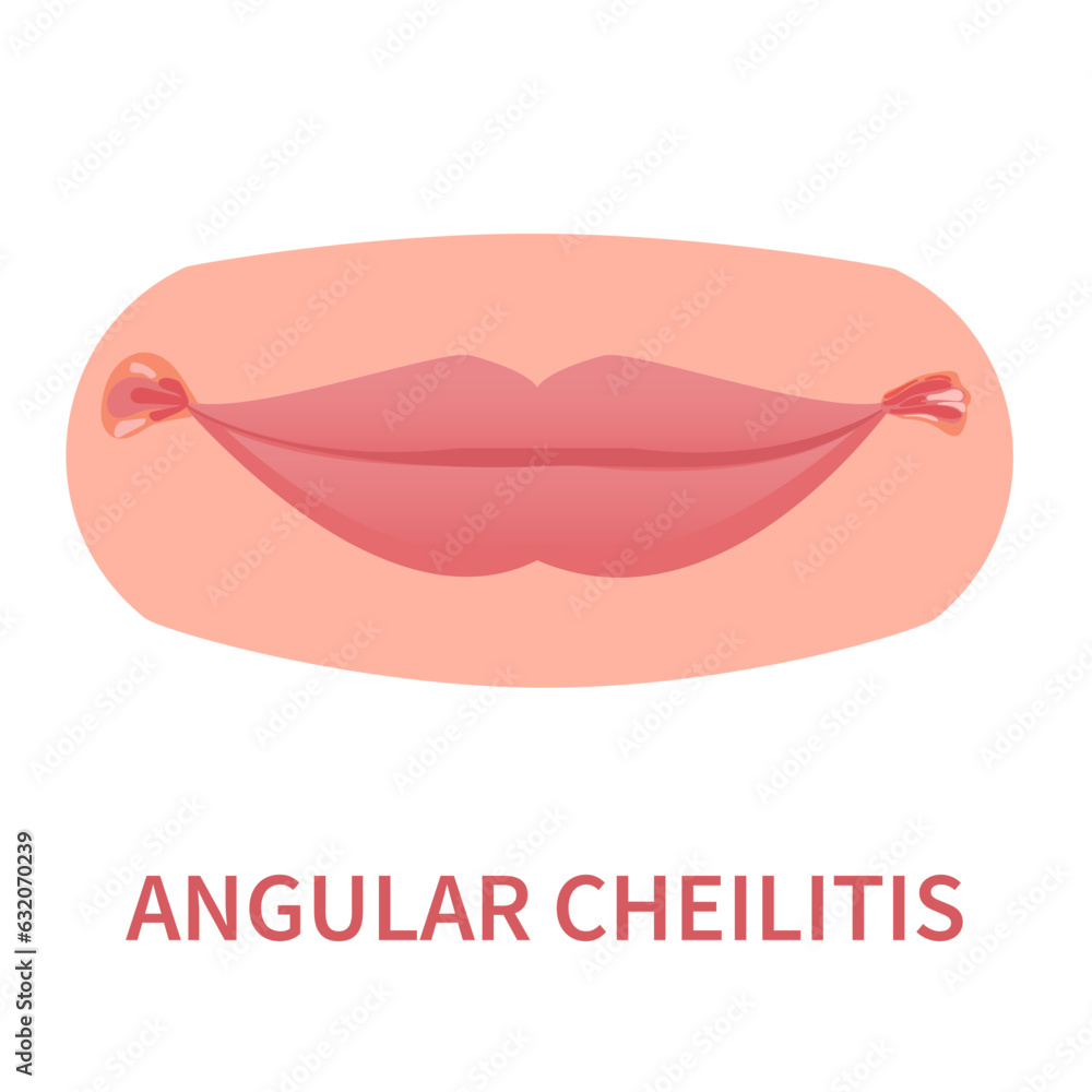 Angular cheilitis oral disease icon. Mouth corner cracks. Lips ...