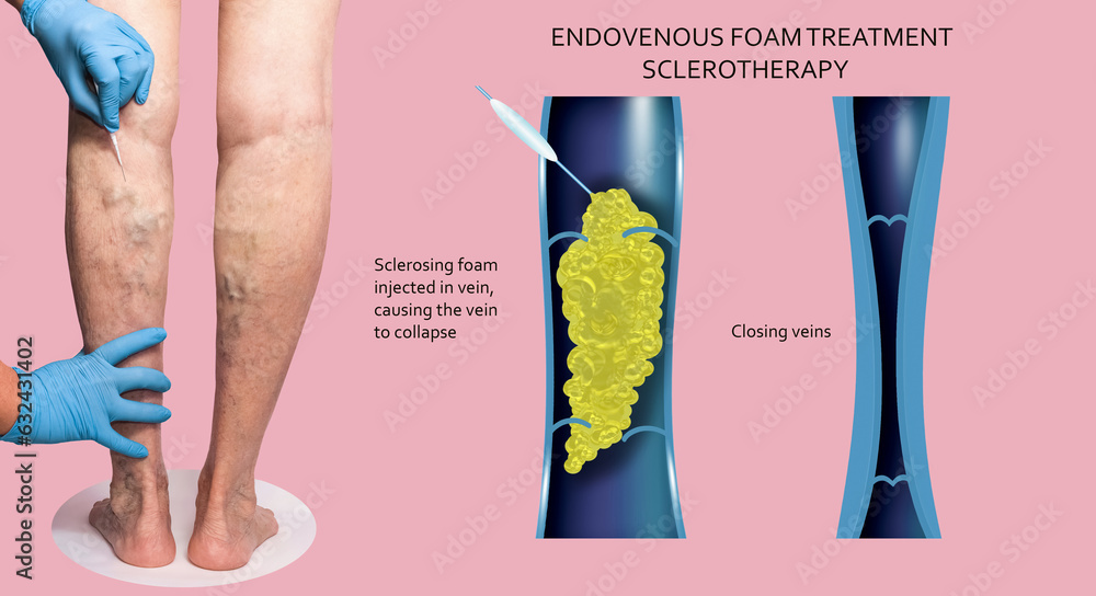 Endovenous laser treatment for varicose veins - foam sclerotherapy ...
