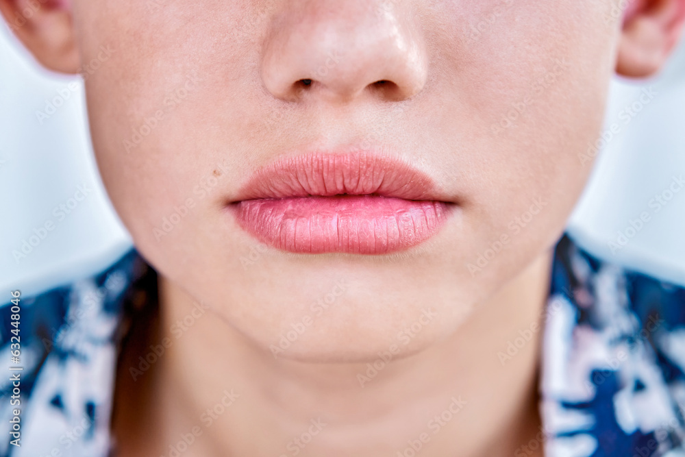 Chapped lips of preteen schoolboy from dry weather on sea resort ...
