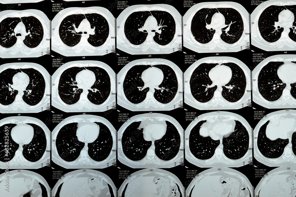Photo & Art Print Multi slice CT scan of the chest showing normal study ...