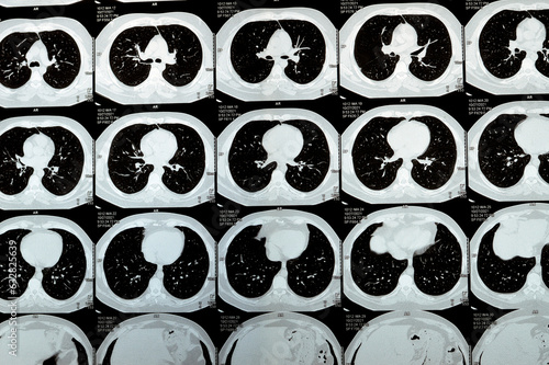 Plakat Multi slice CT scan of the chest showing normal study, normal ...