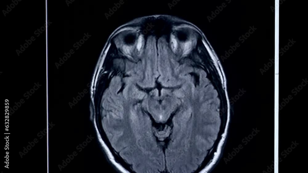 Brain MRI head scans and tumor detection black and white diagram ...