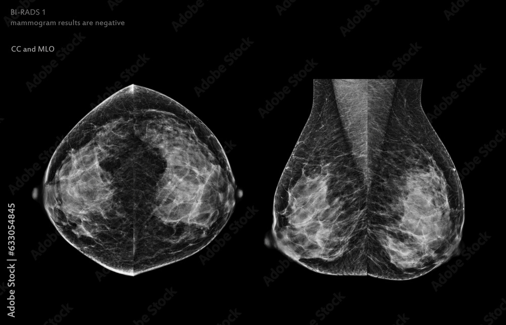 X-ray Digital Mammogram of Both side CC view and MLO view. Stock ...