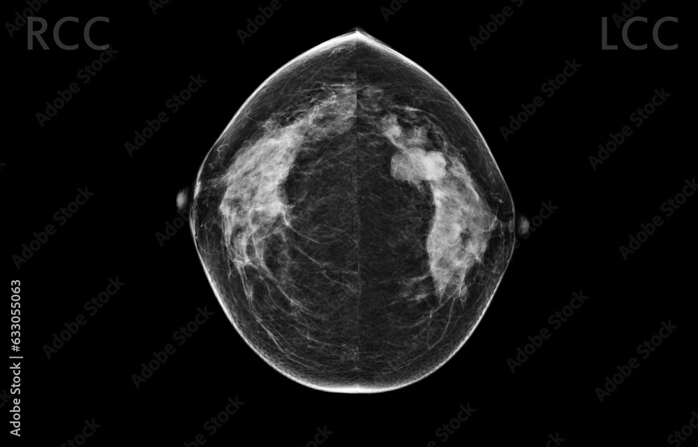 Photo & Art Print X-ray Digital Mammogram both side CC view, samunella