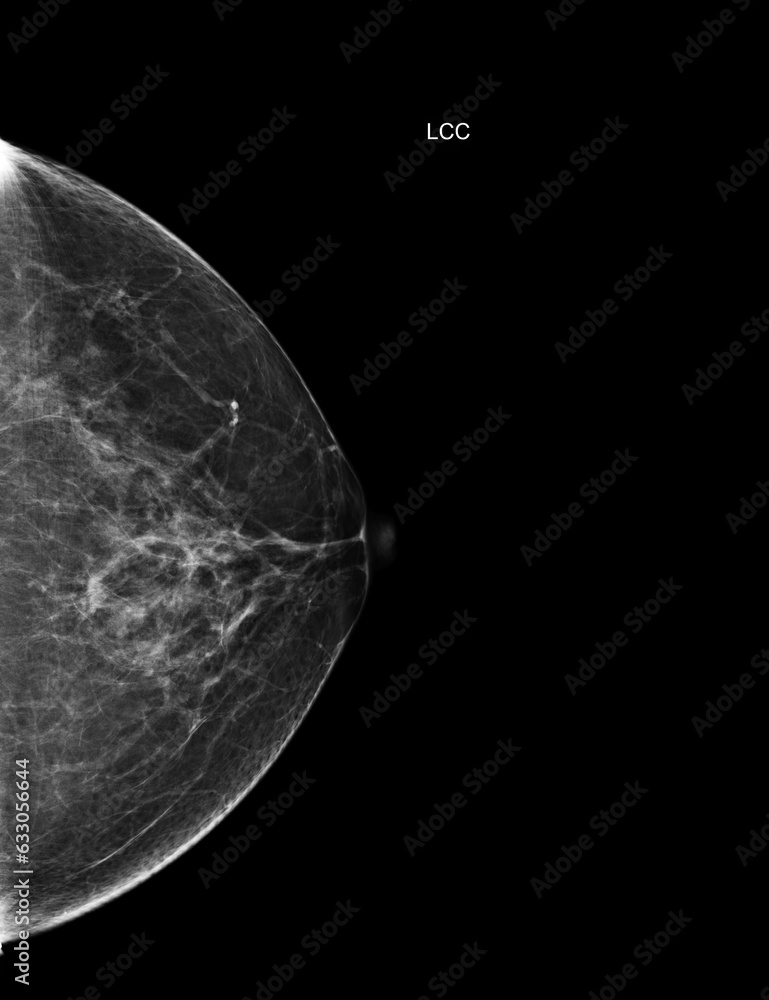 X-ray Digital Mammogram Left side CC view . mammography or breast scan ...