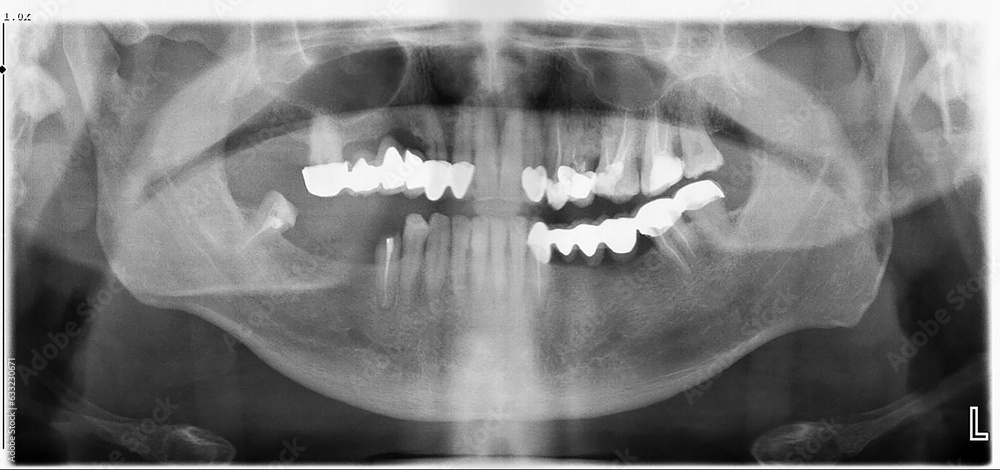 Panoramic x-ray of the mouth. - t-The upper and lower jaws. for oral ...