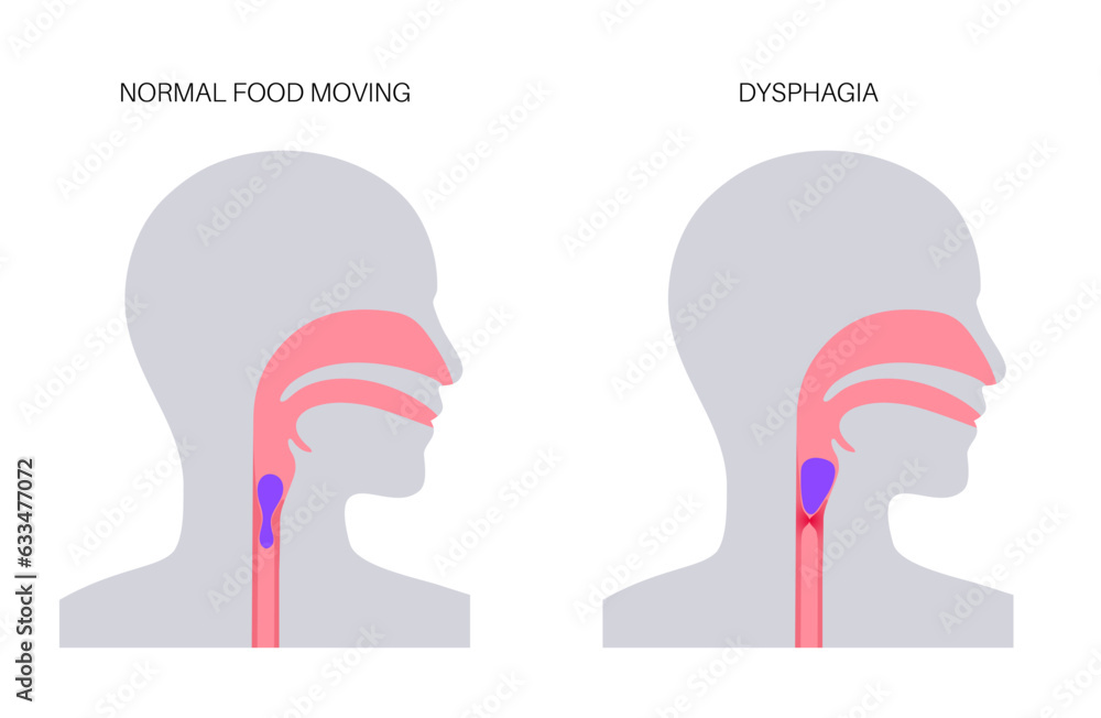 Dysphagia medical poster Stock Vector | Adobe Stock