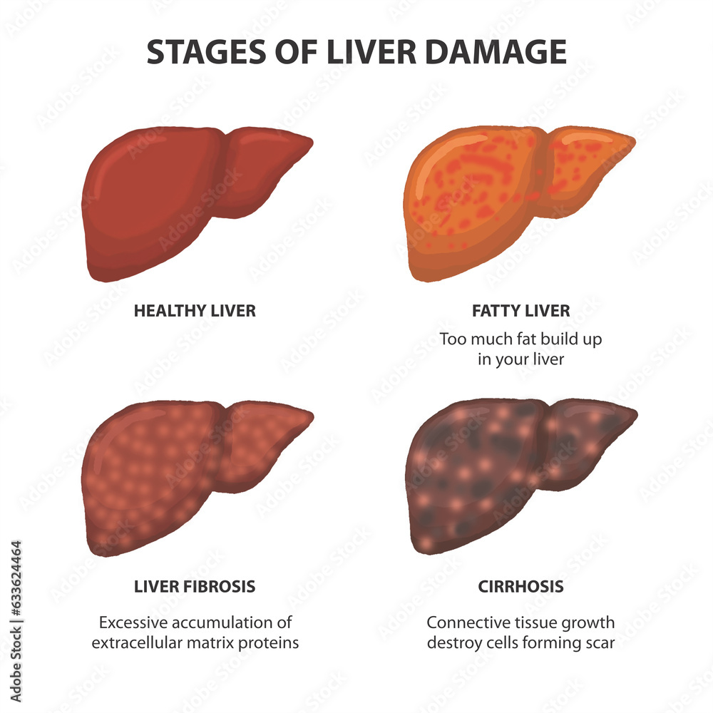 Stages of liver damage Stock Illustration | Adobe Stock