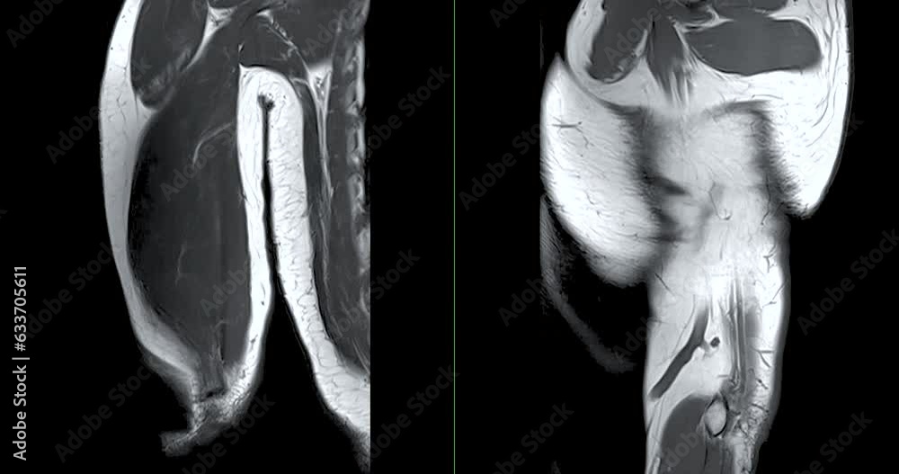MRI Left humerus bone for diagnosis bone tumor. Stock 비디오 | Adobe Stock