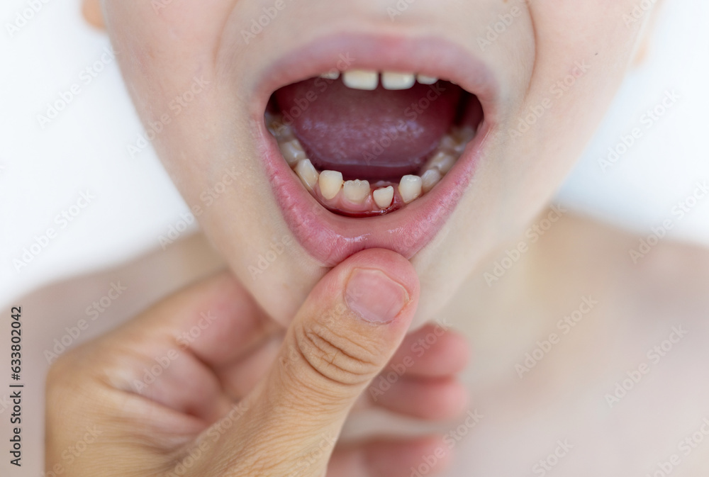 one kid child tooth is falling, permanent raised from back.bloody teeth ...