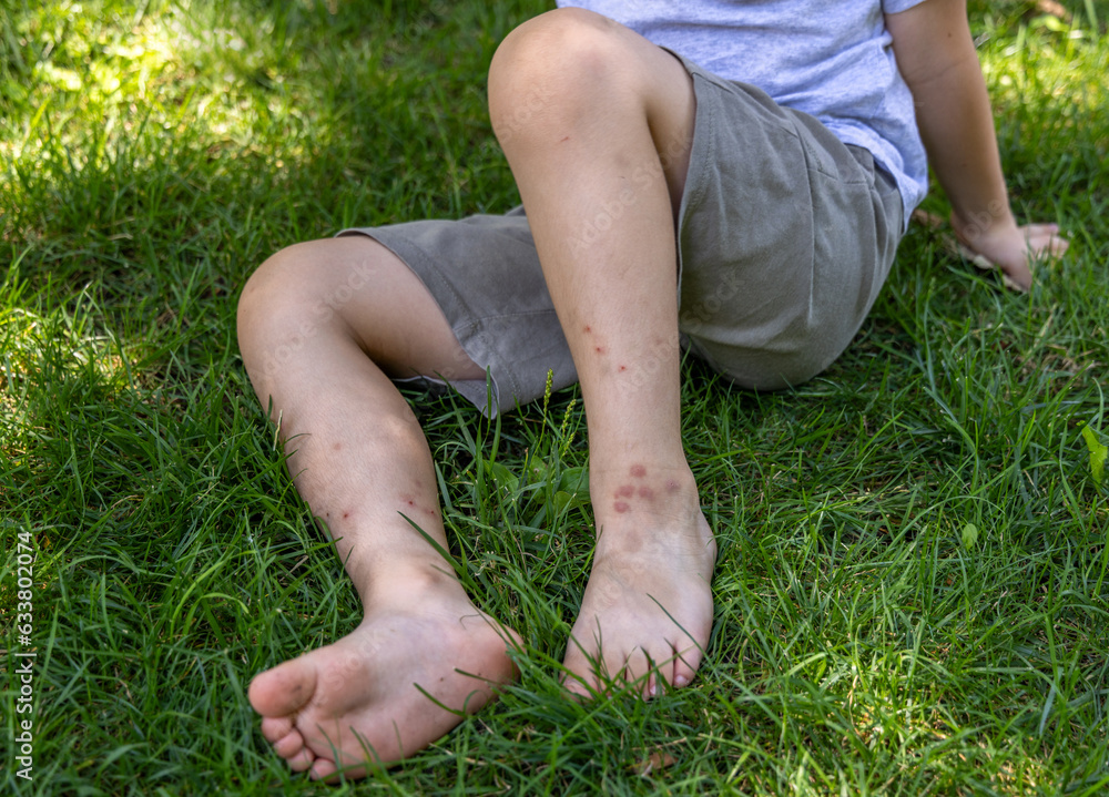 kid legs with insects mosquito bites wound on skin. child boy sitting ...