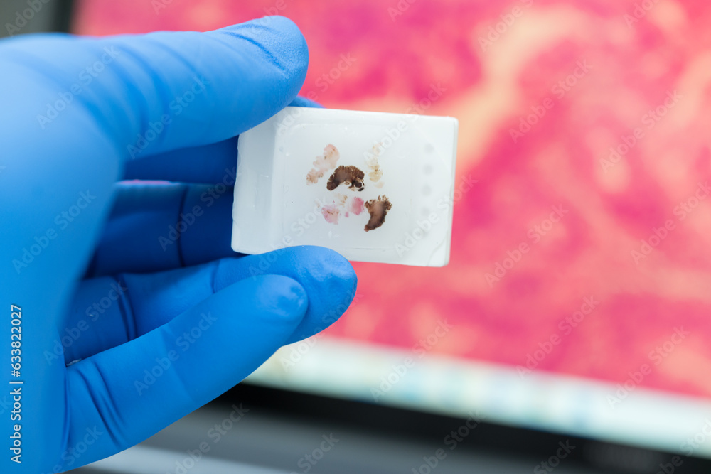 Scientist wear blue glove holding parafin human tissue block..Biopsy in ...