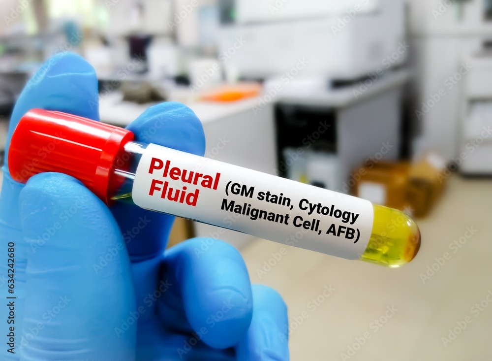 Pleural fluid analysis for GM stain, Cytology, Malignant Cell and AFB ...
