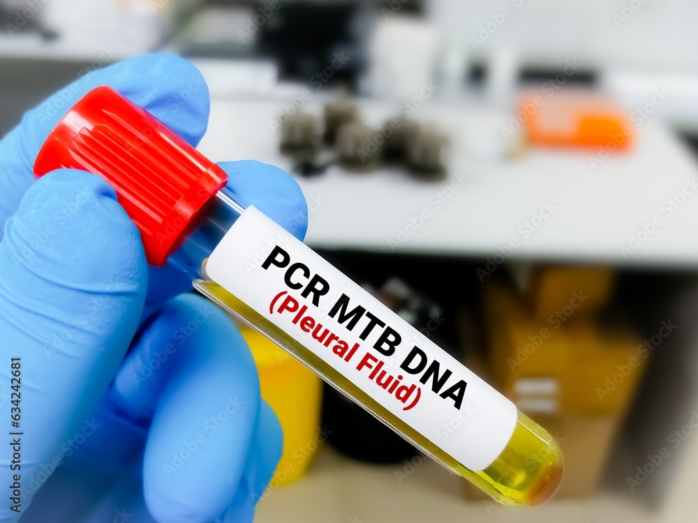 Pleural fluid for PCR MTB DNA gene Xpert test, to diagnose TB. Stock ...