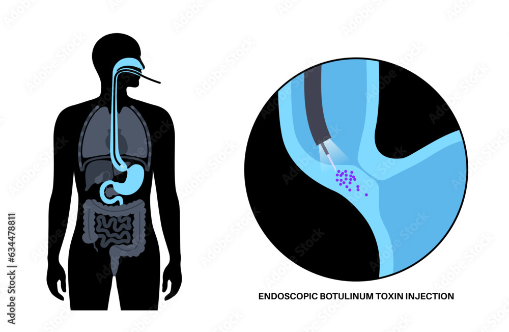 esophageal botulinum toxin injection Stock Vector | Adobe Stock