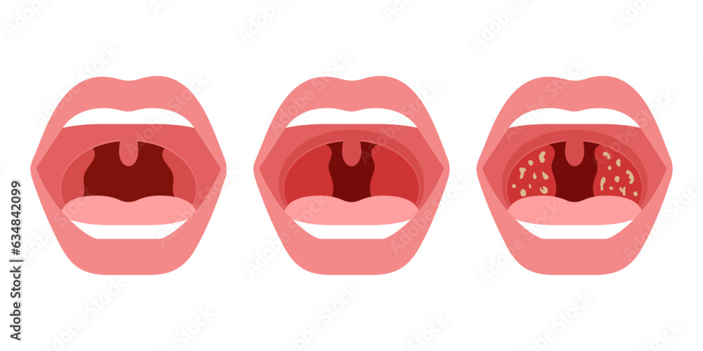 Open mouth with health and sick throat of human. Comparison healthy ...