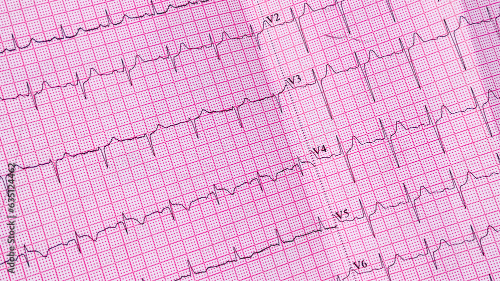 Rhythm beat pulse rate red grid paper that shows sinus rhythm ...